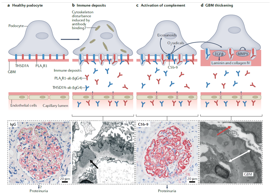 Advancements in Membranous Nephropathy - WuXi Biology