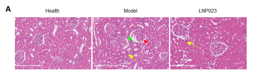 Advancements in Membranous Nephropathy - WuXi Biology