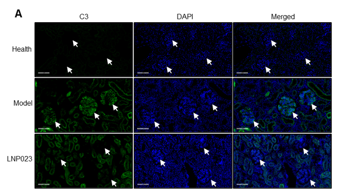 Advancements in Membranous Nephropathy - WuXi Biology